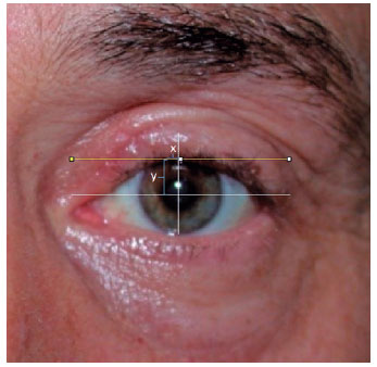 Arquivos Brasileiros de Oftalmologia - Digital analysis of unilateral ...