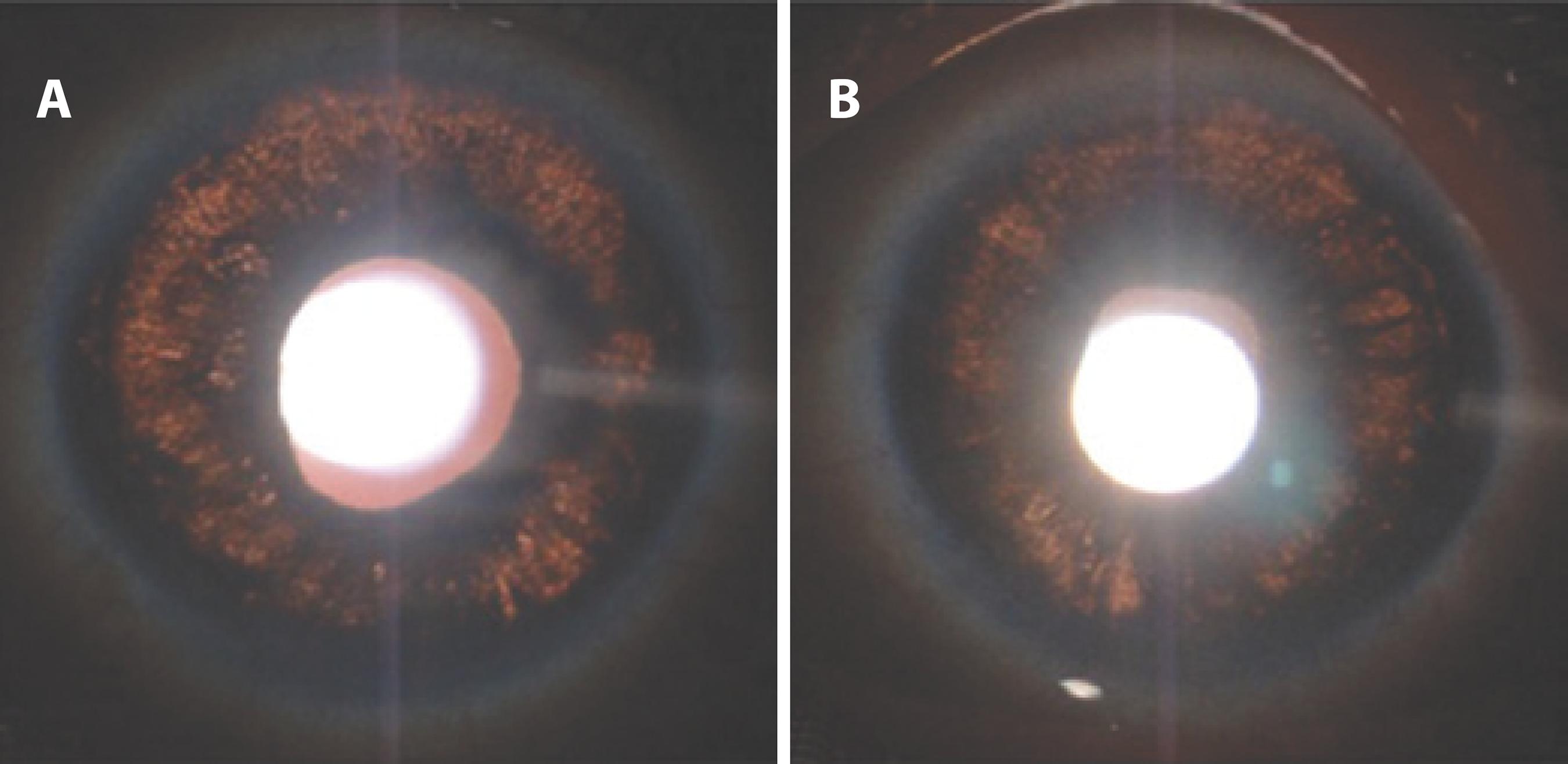 Arquivos Brasileiros De Oftalmologia Bilateral Acute Iris